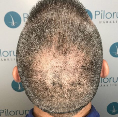 Pilorum hårklinik | effektiv behandling imod hårtab | Læs mere