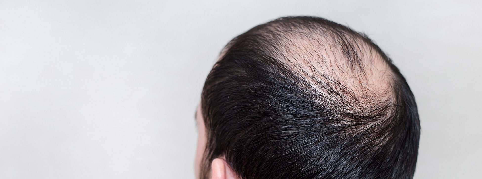 De mest almindelige årsager til hårtab - Pilorum Hårklinik
