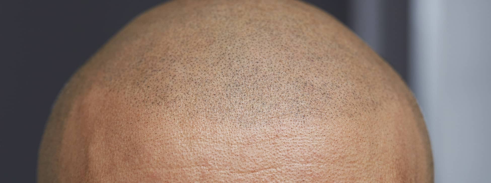 10 gode grunde til at vælge hovedbundspigmentering (SMP) - Pilorum ...