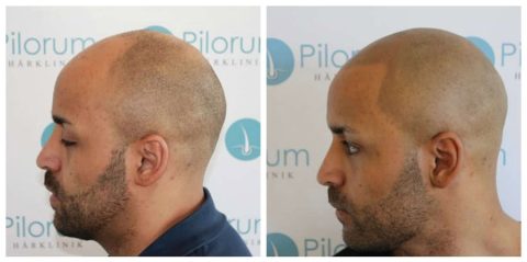 Pilorum hårklinik | effektiv behandling imod hårtab | Læs mere