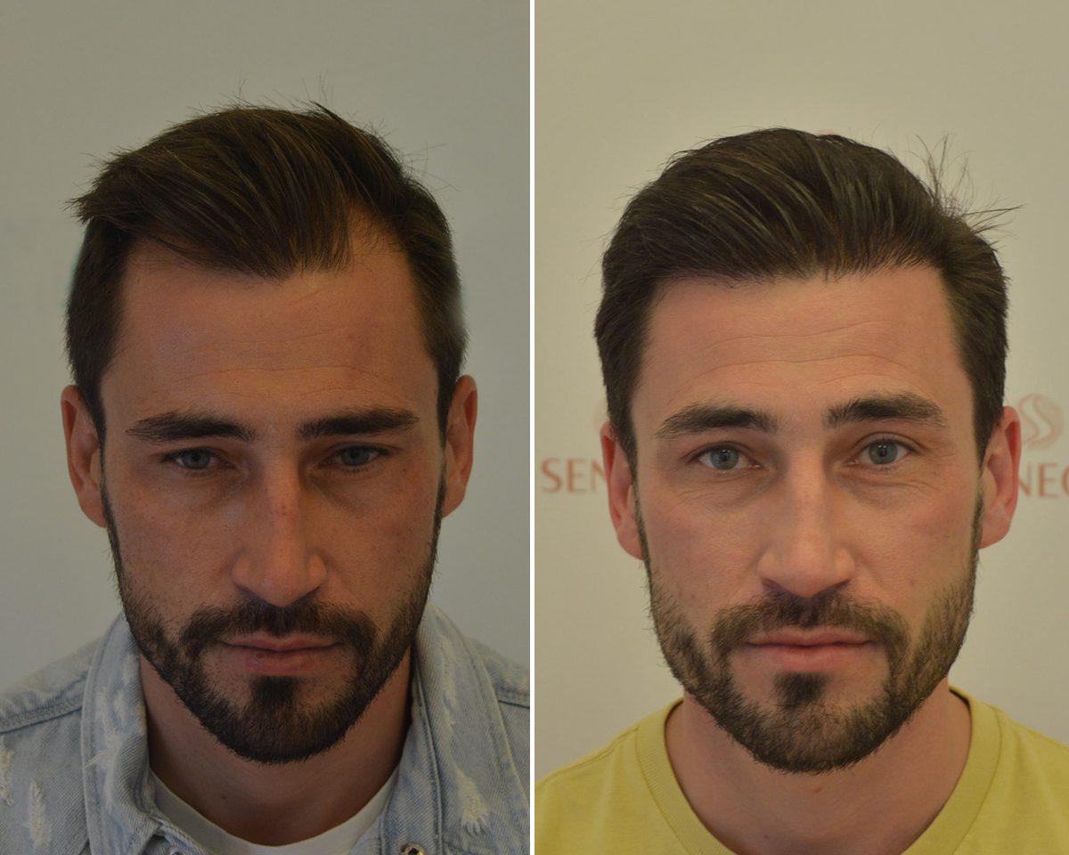 Før & efter billeder - Pilorum Hårklinik