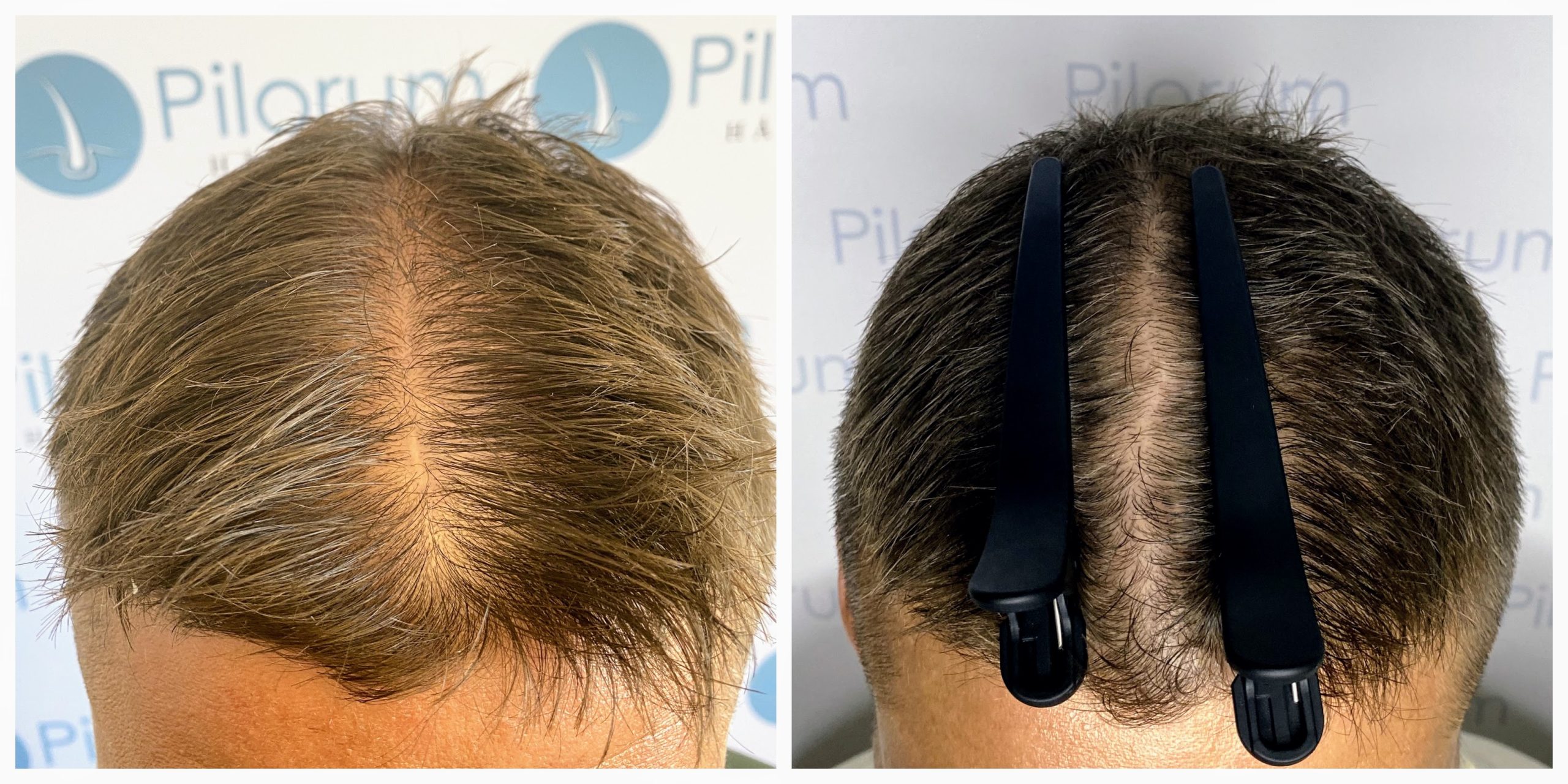 V2X® behandling - Pilorum Hårklinik