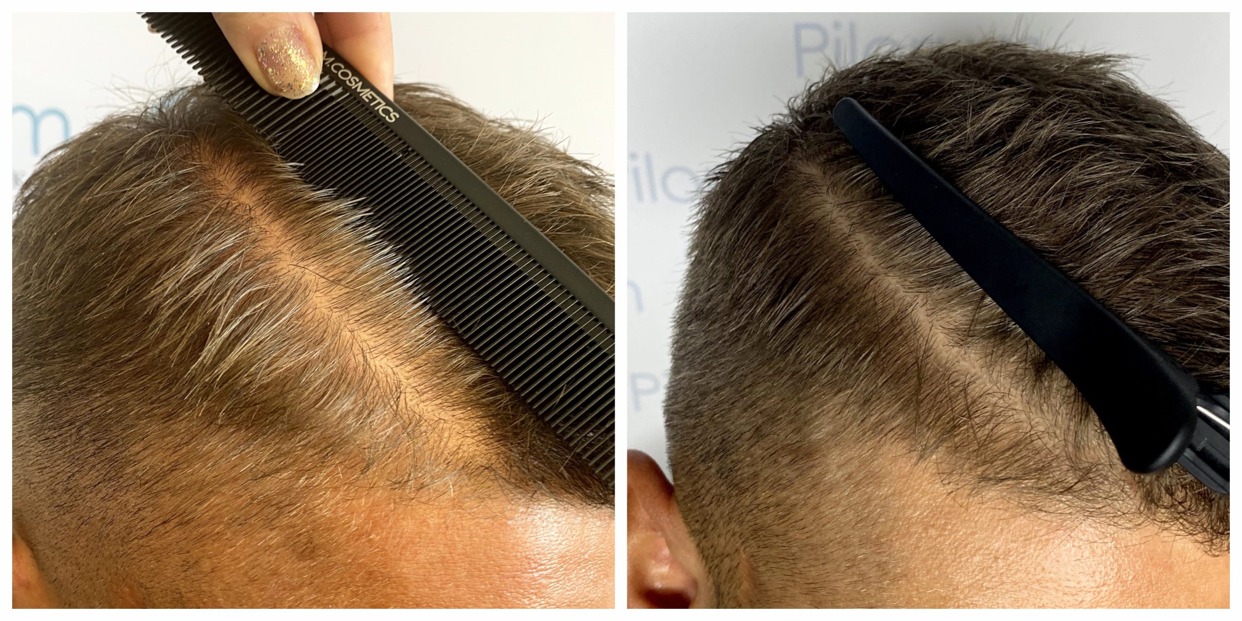 V2X® behandling - Pilorum Hårklinik